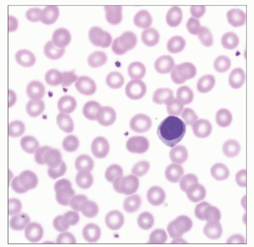 Lymphoplasmacytic Lymphoma | Basicmedical Key
