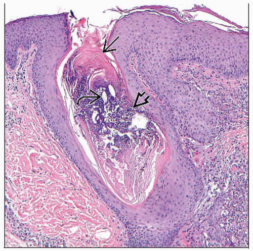 Acne | Basicmedical Key