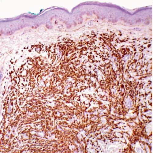 Myeloid Sarcoma | Basicmedical Key