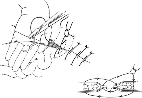 Exploratory Laparotomy Basicmedical Key
