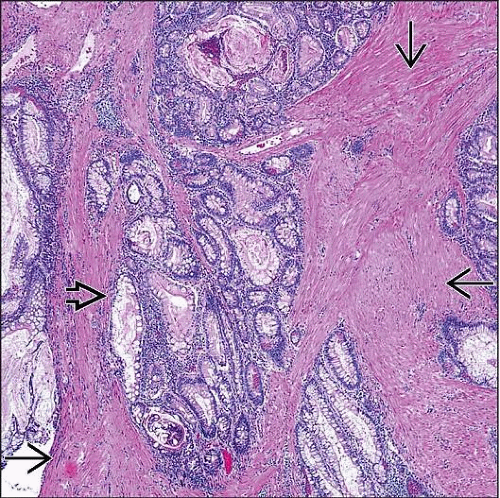 Peutz-Jeghers Syndrome | Basicmedical Key