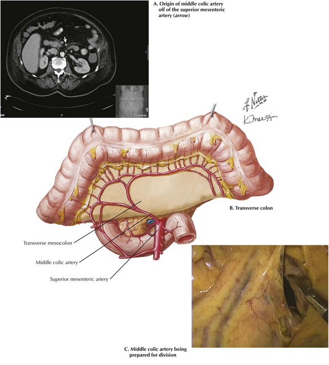 Right Colectomy Basicmedical Key