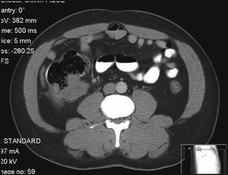 Colectomy Basicmedical Key