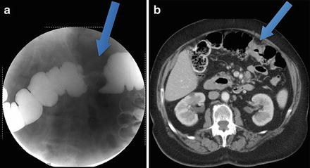 Colectomy Basicmedical Key