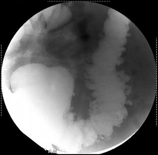 Colectomy Basicmedical Key