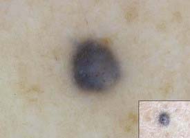 Dermoscopy Basicmedical Key