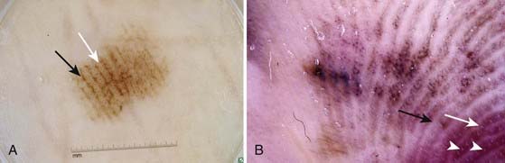 Dermoscopy Basicmedical Key