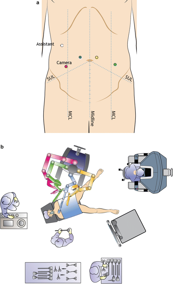 Robotic Left Colectomy Basicmedical Key