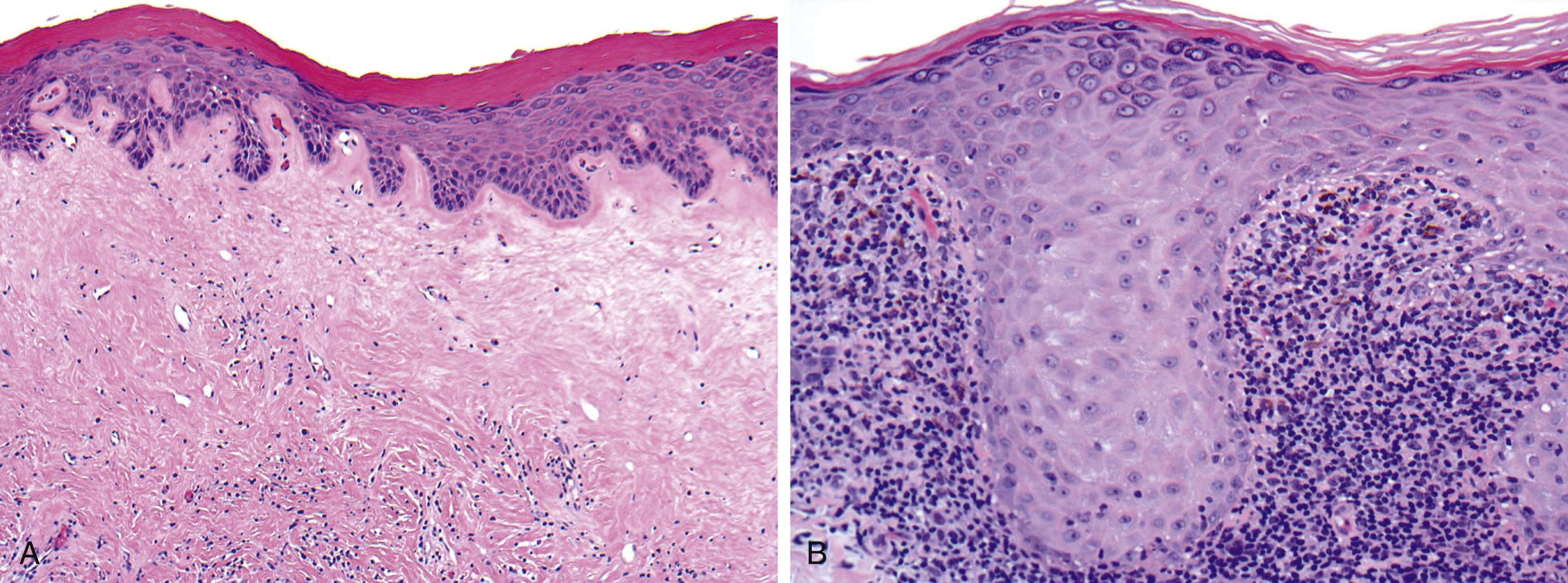 Lichen Simplex Chronicus Histology
